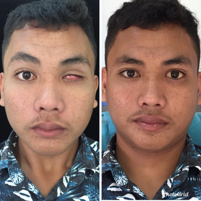 USU as the initiator of the first ocular prosthesis consultation and ...